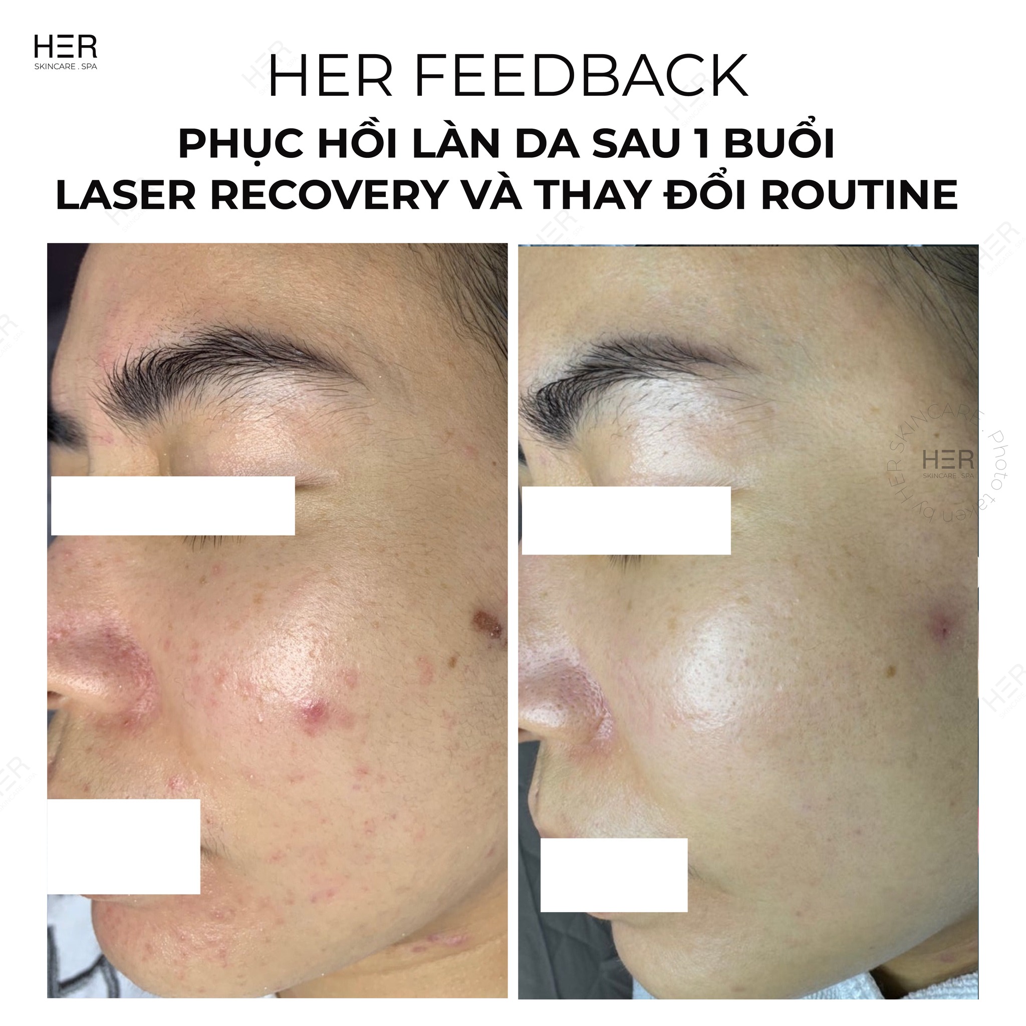 RECOVER NO REDNESS - PHỤC HỒI DA TOÀN DIỆN CÙNG LASER RECOVERY + MESO ...