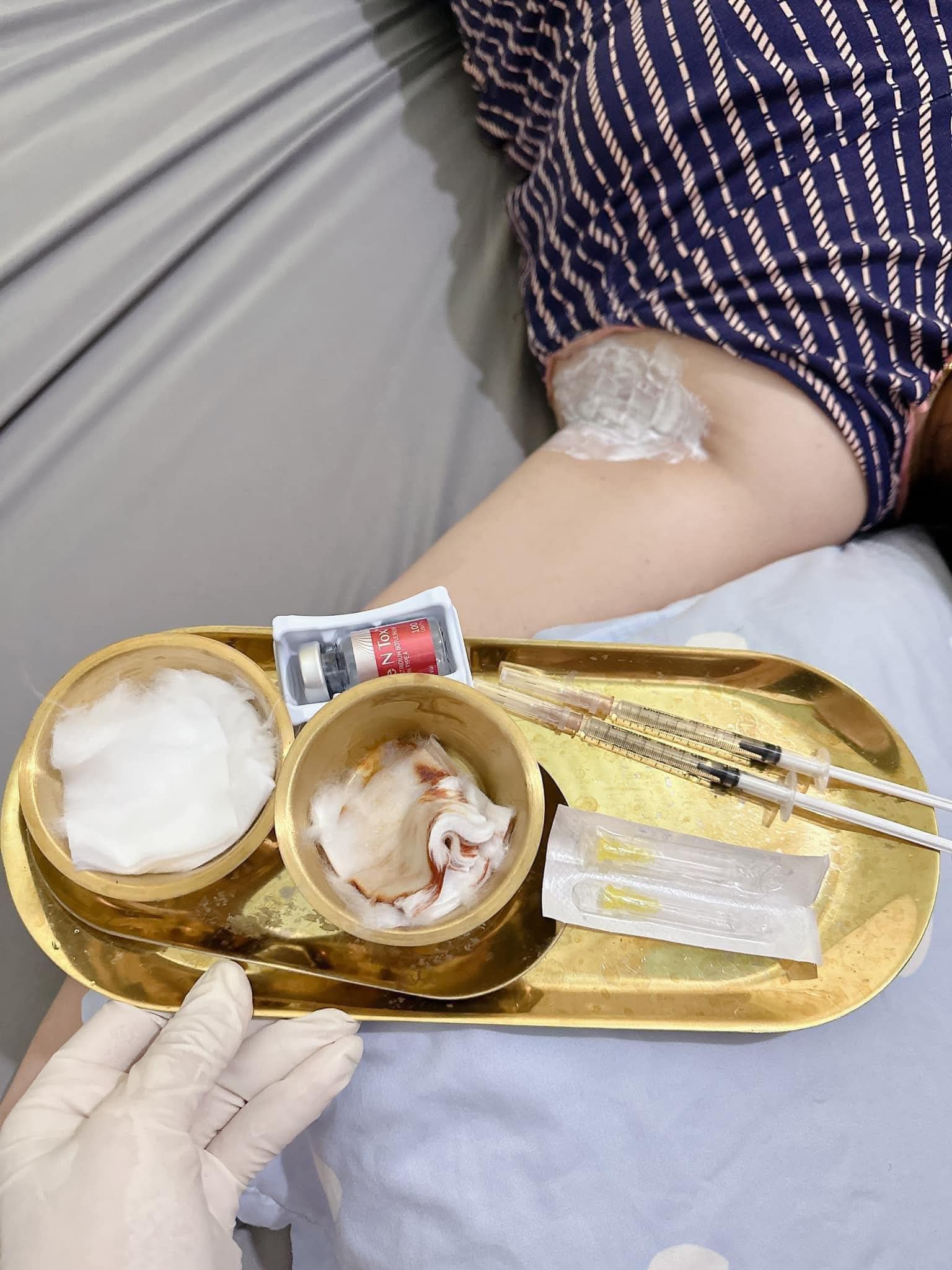 Liệu Trình Botox Điều Trị Hôi Nách Chuẩn Y Khoa