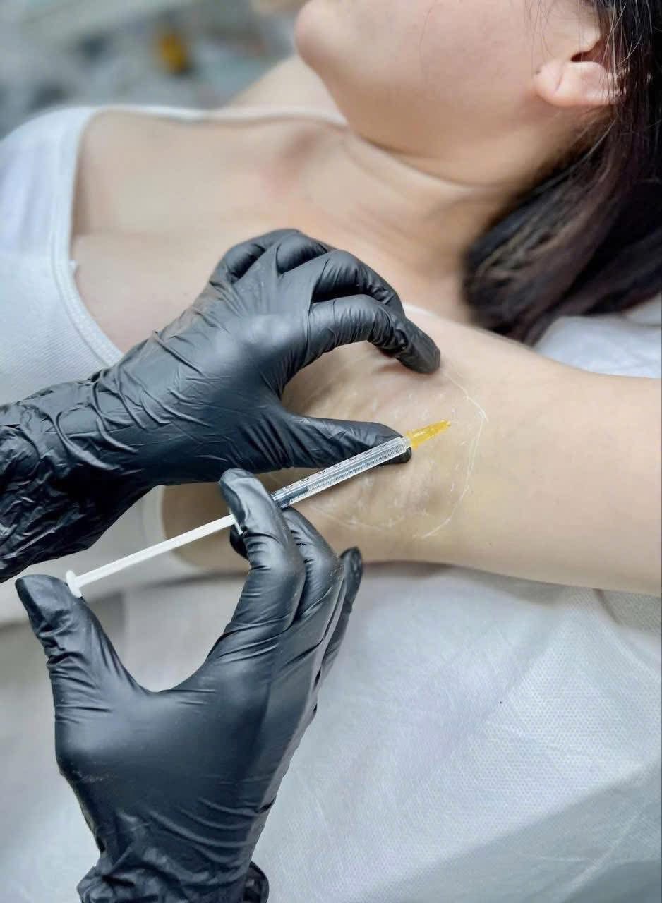 Liệu Trình Botox Điều Trị Hôi Nách Chuẩn Y Khoa