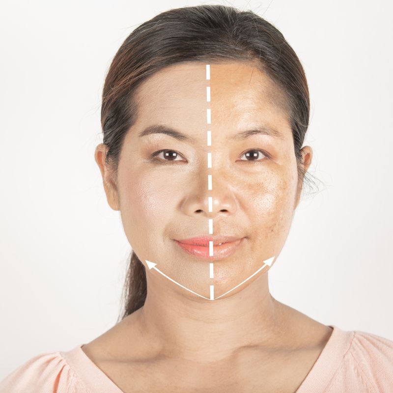 Liệu Trình Làm Sáng Da Thâm Sạm Chuẩn Spa/Clinic