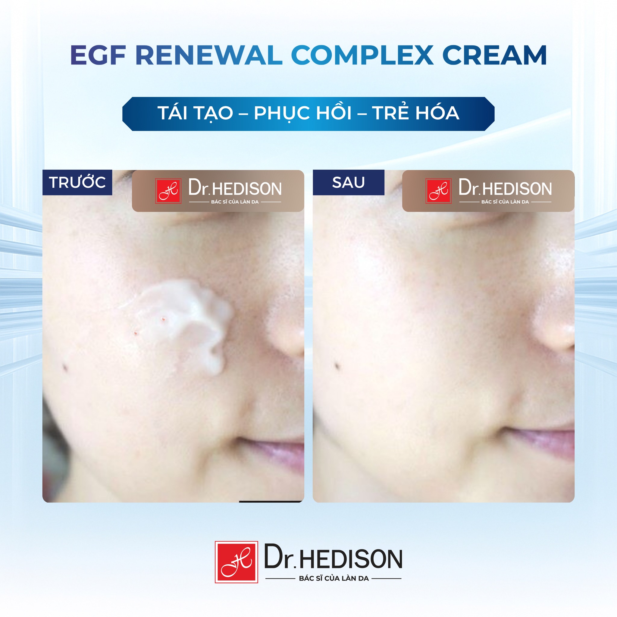 Kem dưỡng tái tạo tế bào gốc EGF Renewal Complex Cream Dr.Hedison 50ml