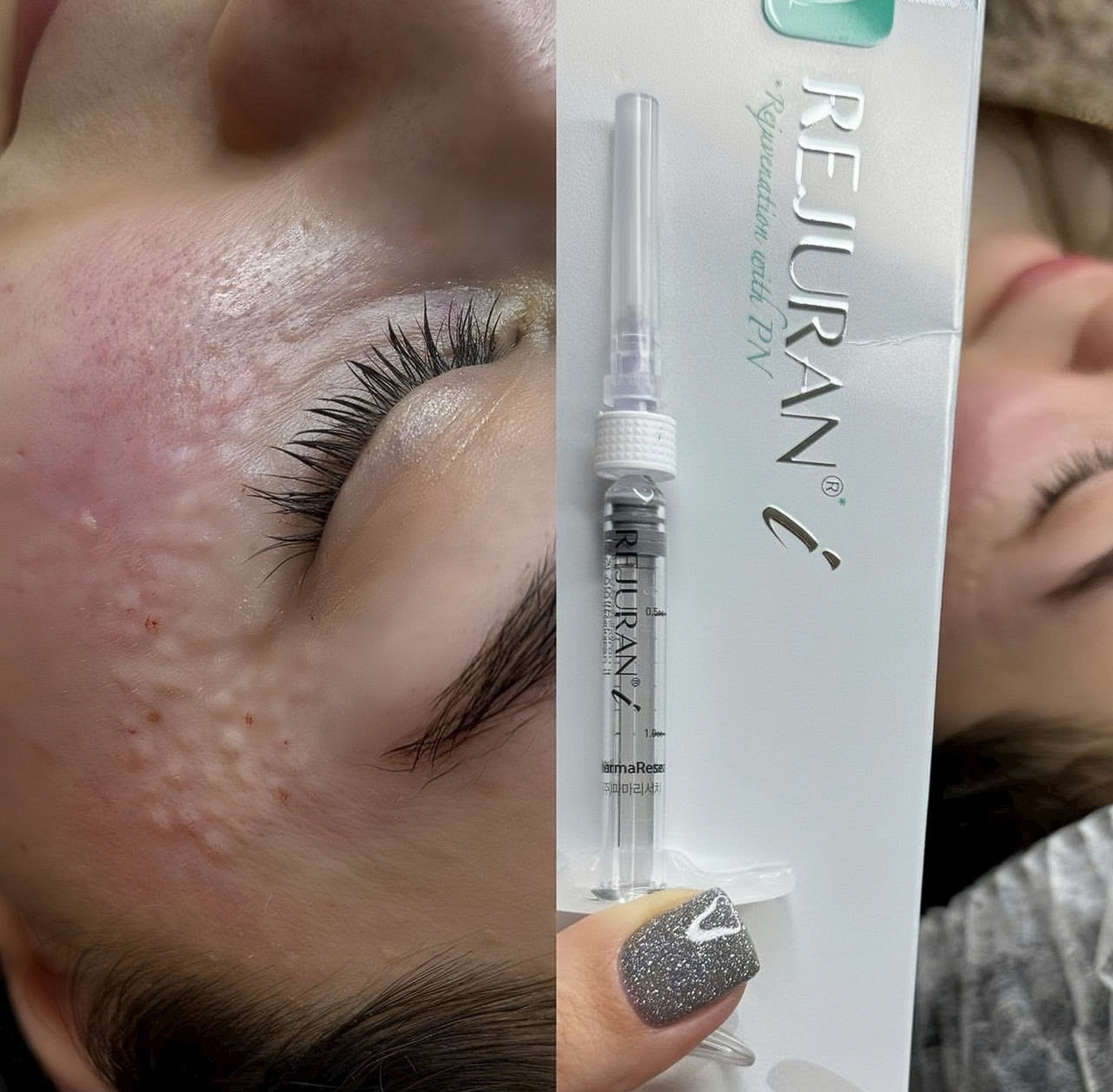 REJURAN i- Meso trẻ hóa da vùng mắt Hộp 1ml