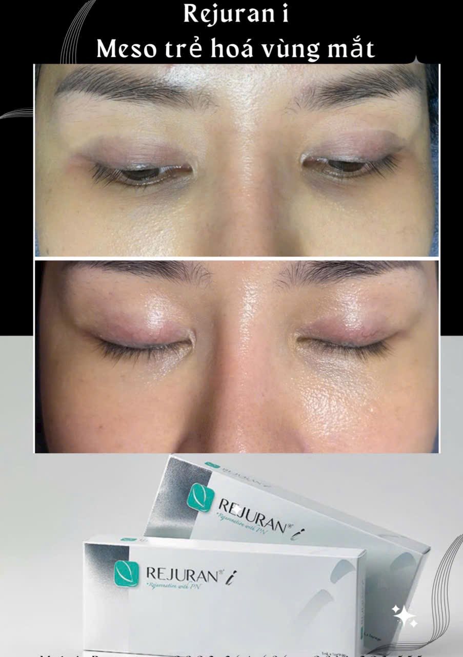 REJURAN i- Meso trẻ hóa da vùng mắt Hộp 1ml