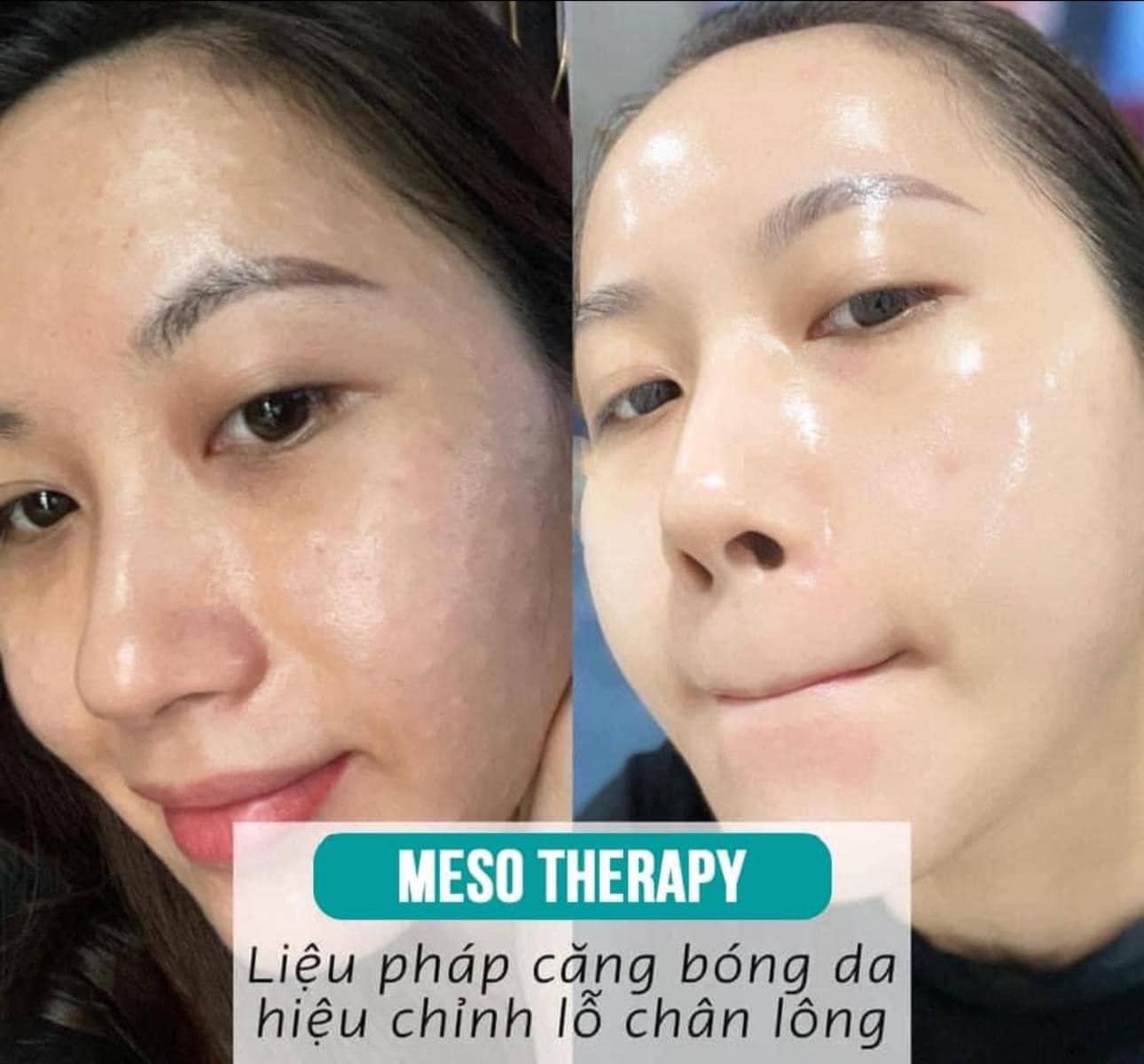 Bao Lâu Thì Nên Tiêm Meso Một Lần?