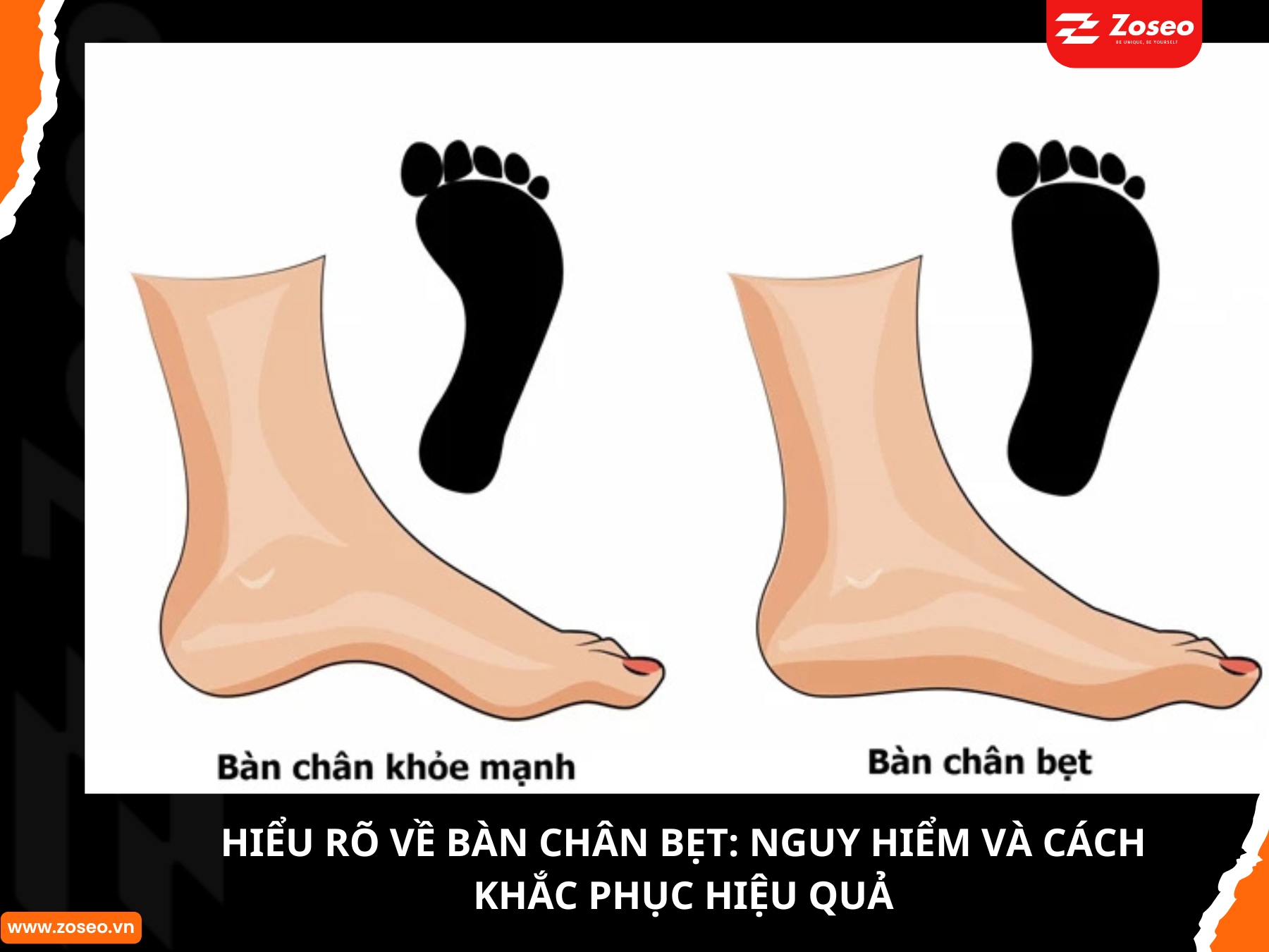 Hiểu Rõ Về Bàn Chân Bẹt: Nguy Hiểm Và Cách Khắc Phục Hiệu Quả